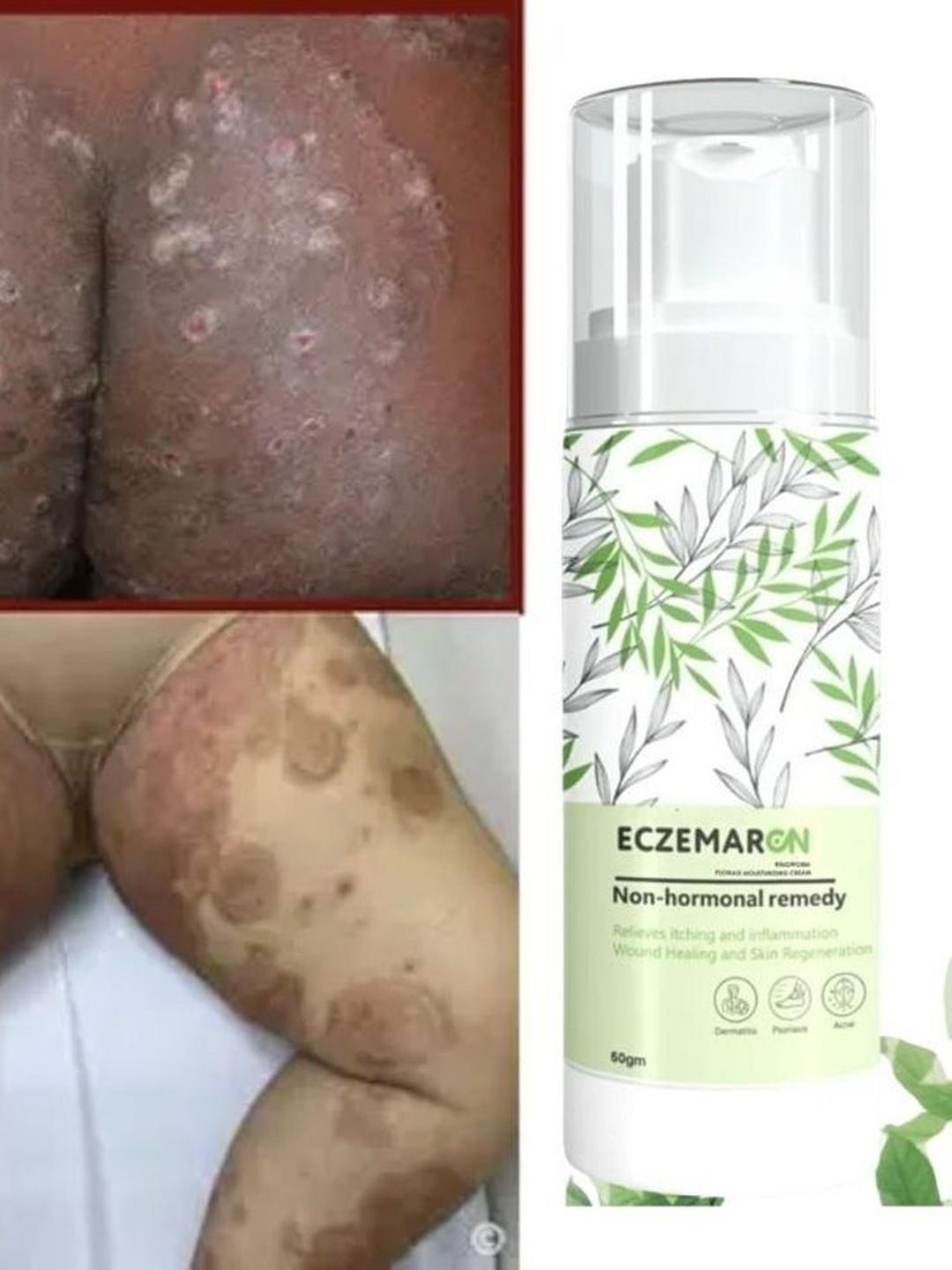 Buy Lorshel Eczem Aron Anti Fungl Cream Antifungal Protection Body ...